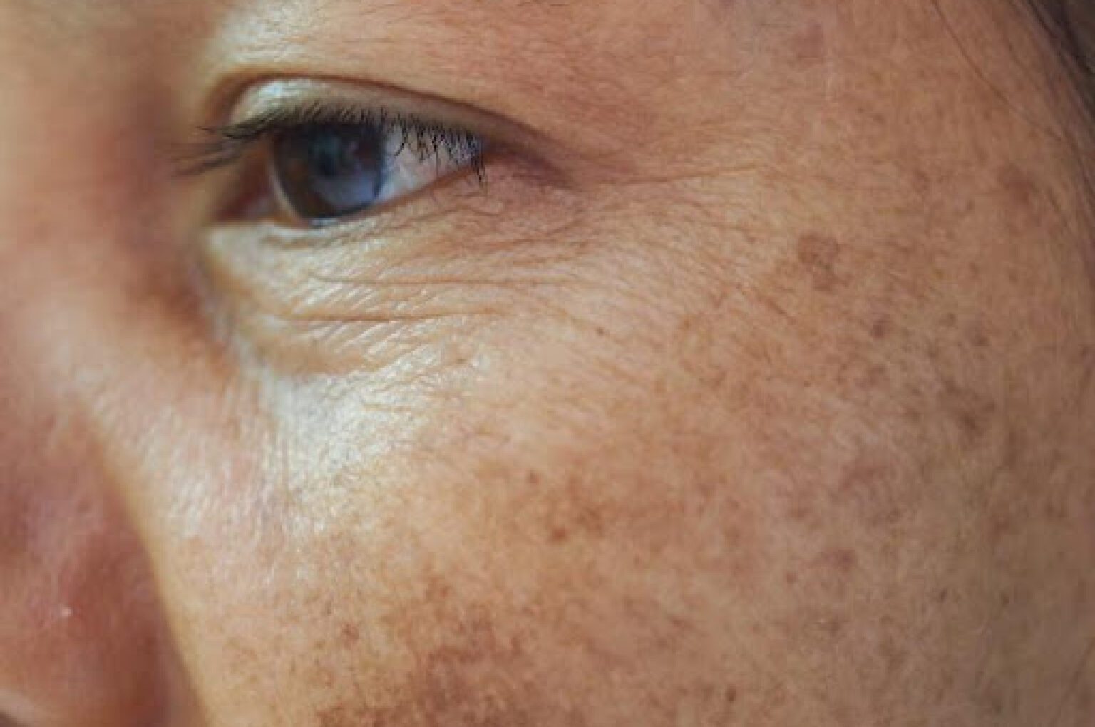 Unveiling the Mystery: Dark Spots Causes and Effective Cures - My ...